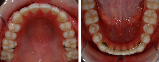 Occlusion traumatique dentaire; Occlusion dentaire traumatique