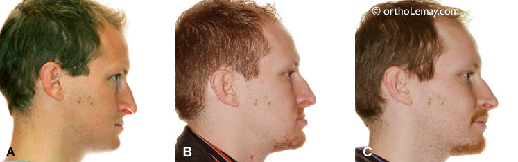 Comment avoir une grosse machoire