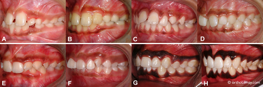 Dentition normale et occlusion normale | Bücco