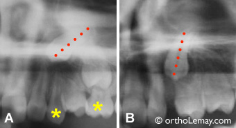 Impacted and ectopic canines