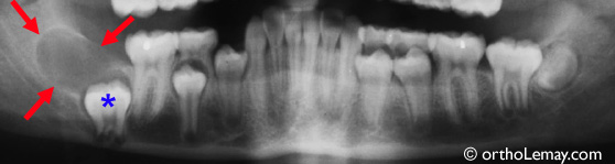 Radiographies et diagnostic en orthodontie | Orthodontiste Sherbrooke