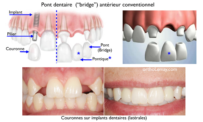 Anodontie des incisives latérales, absence congénitale et correction ...