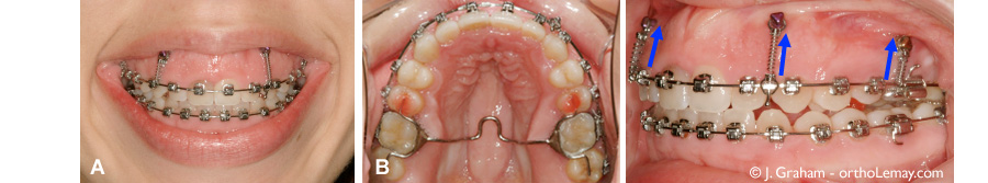 Exemple de cas cliniques en orthodontie | Bücco
