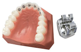 Les broches linguales : broches invisibles en orthodontie | Bücco