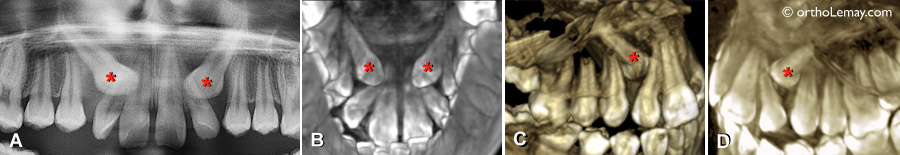 Extractions de canines permanentes | Bücco