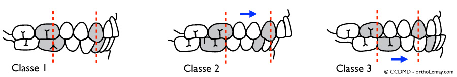 Malocclusions dentaires "Classe 3" traitées en orthodontie | Bücco