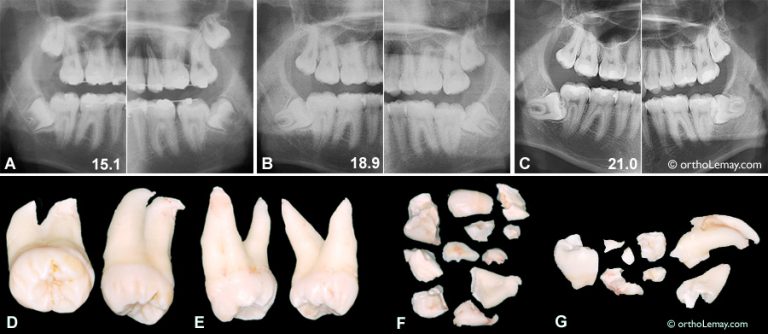 Wisdom teeth – Myths and realities | Bücco