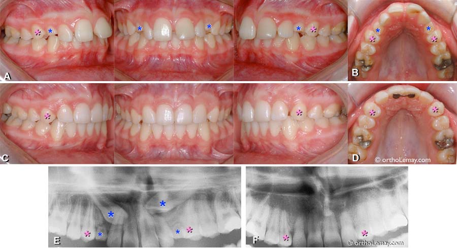 Extractions de canines permanentes | Bücco