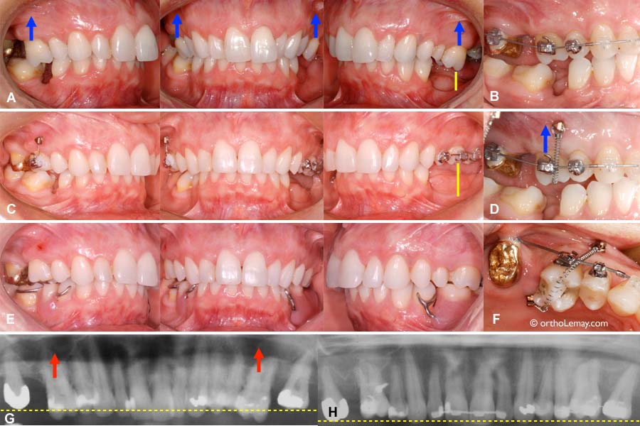 Mini-vis d’ancrage temporaire utilisées en orthodontie | Bücco