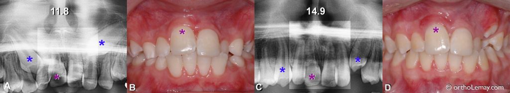 Résorption radiculaire et imagerie | Bücco