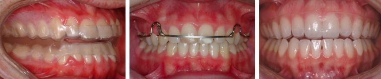 Orthodontic retention | Bücco Orthodontie, par vos orthodontistes