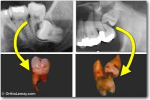 Wisdom teeth – Myths and realities | Bücco