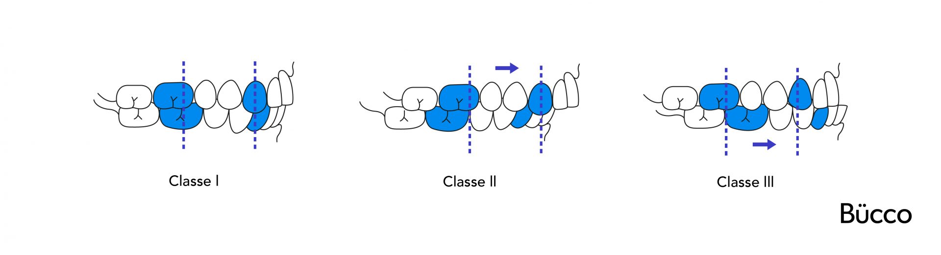 Malocclusions dentaires et traitement orthodontique | Bücco