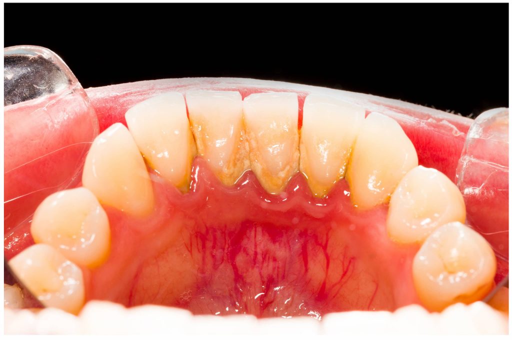 Comprendre et combattre la gingivite | Bücco Orthodontie, par vos ...